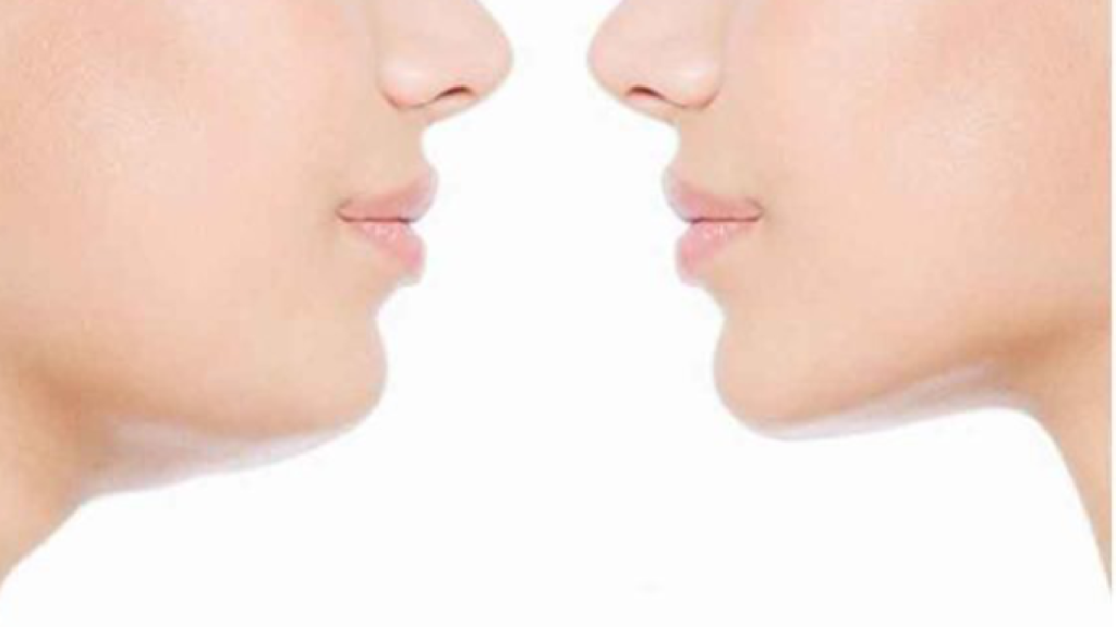 DOBLE CHIN TREATMENT - DR Igor Ramos